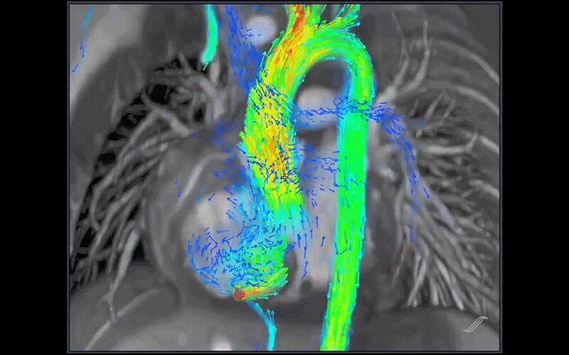 Soluções para cardiologia — Estenose aórtica | GE Healthcare