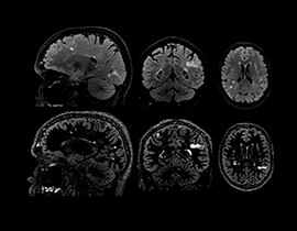Aplicação Cube neuro RM | GE HealthCare