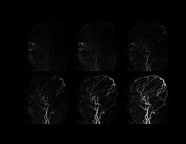 TRICKS Aplicação de RM Neuro | GE HealthCare